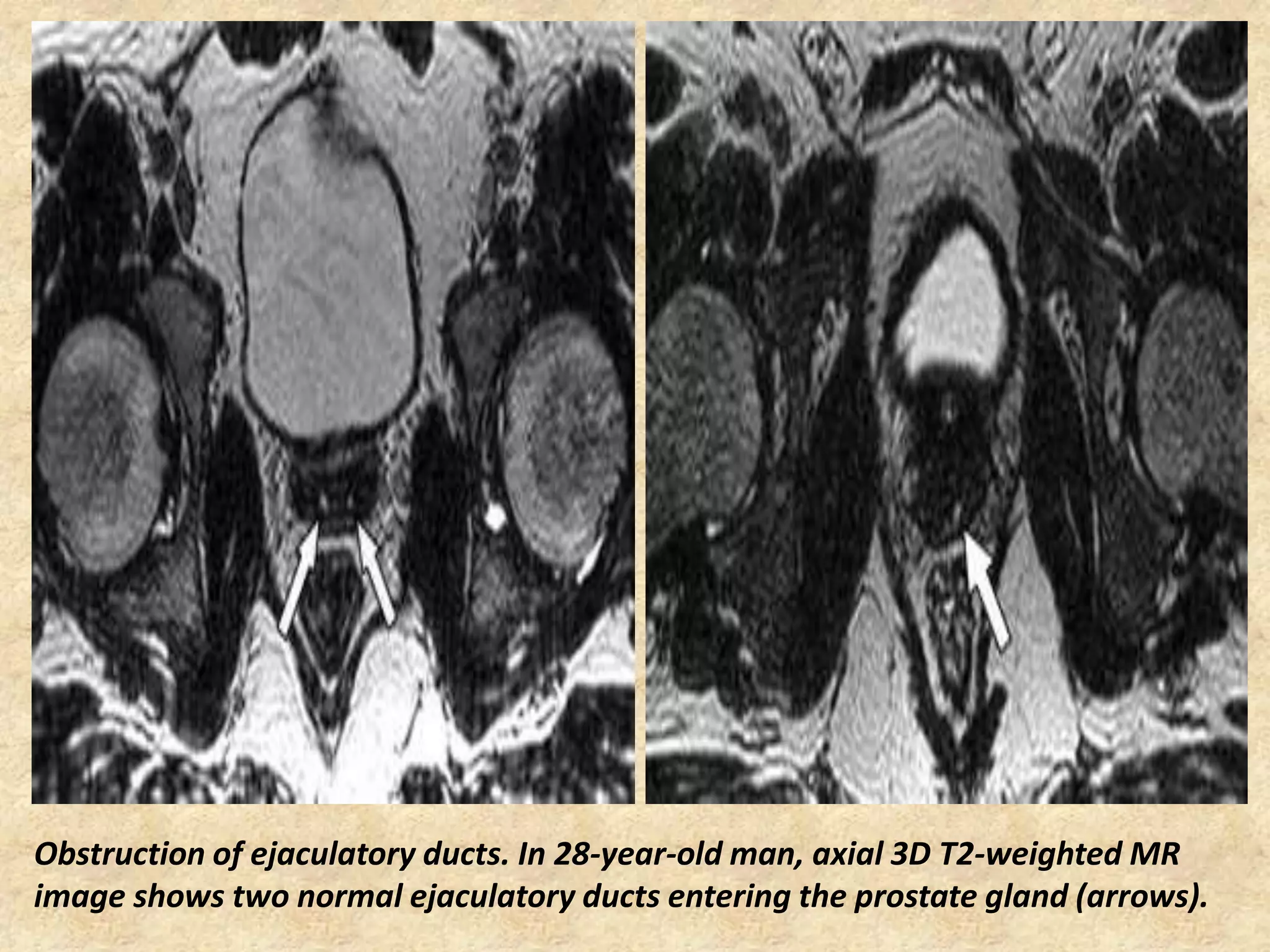 Presentation1.pptx, radiological imaging of male infertility. | PPTX