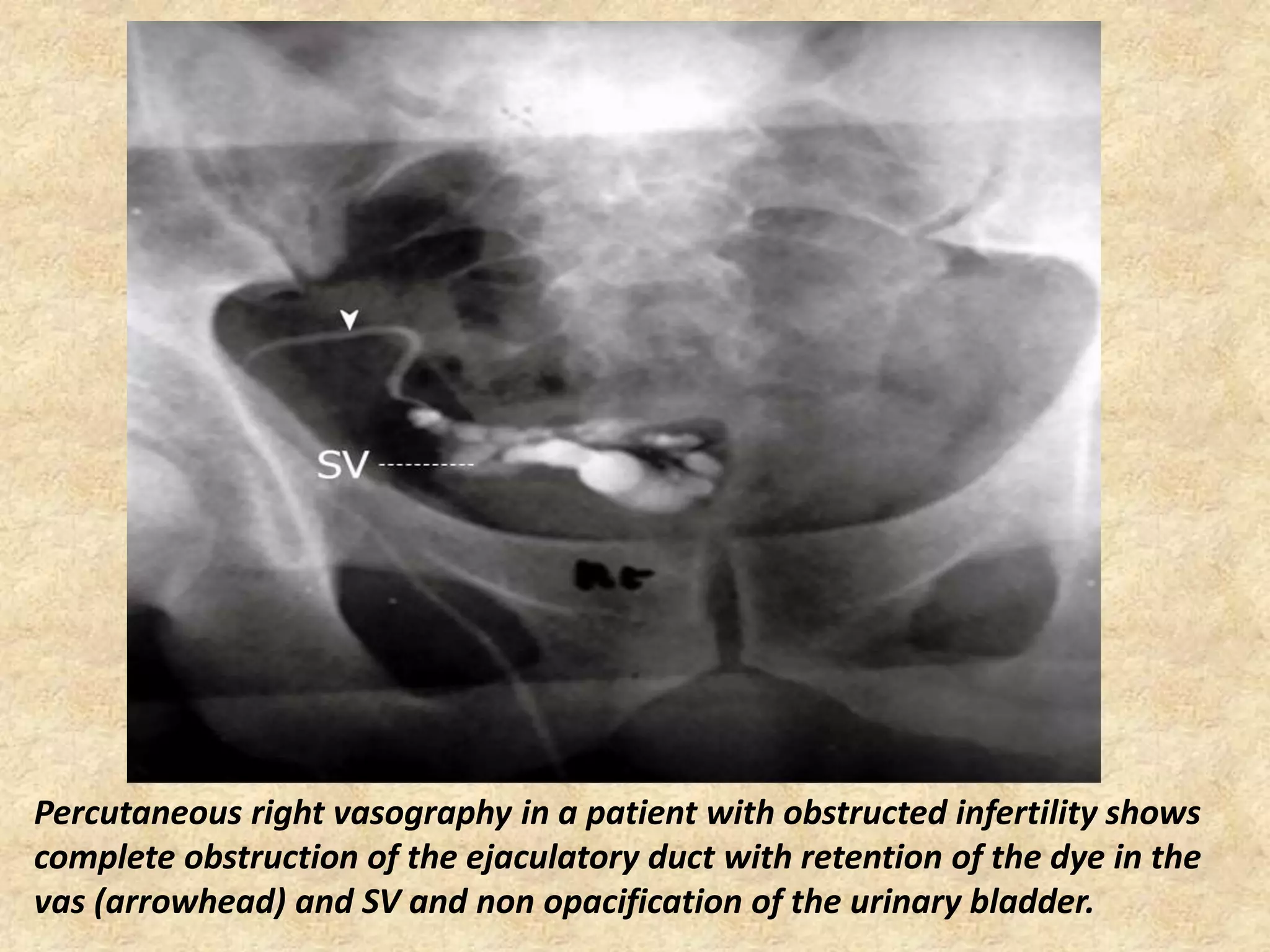 Presentation1.pptx, radiological imaging of male infertility. | PPTX