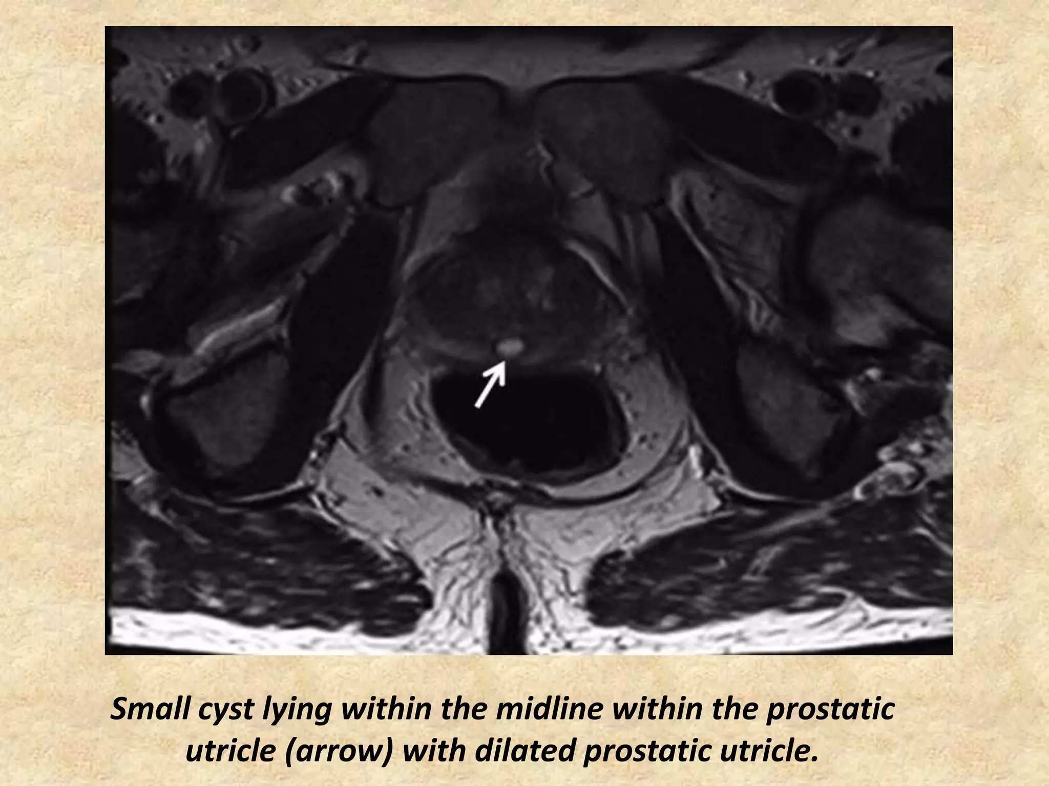 Presentation1.pptx, radiological imaging of male infertility. | PPTX