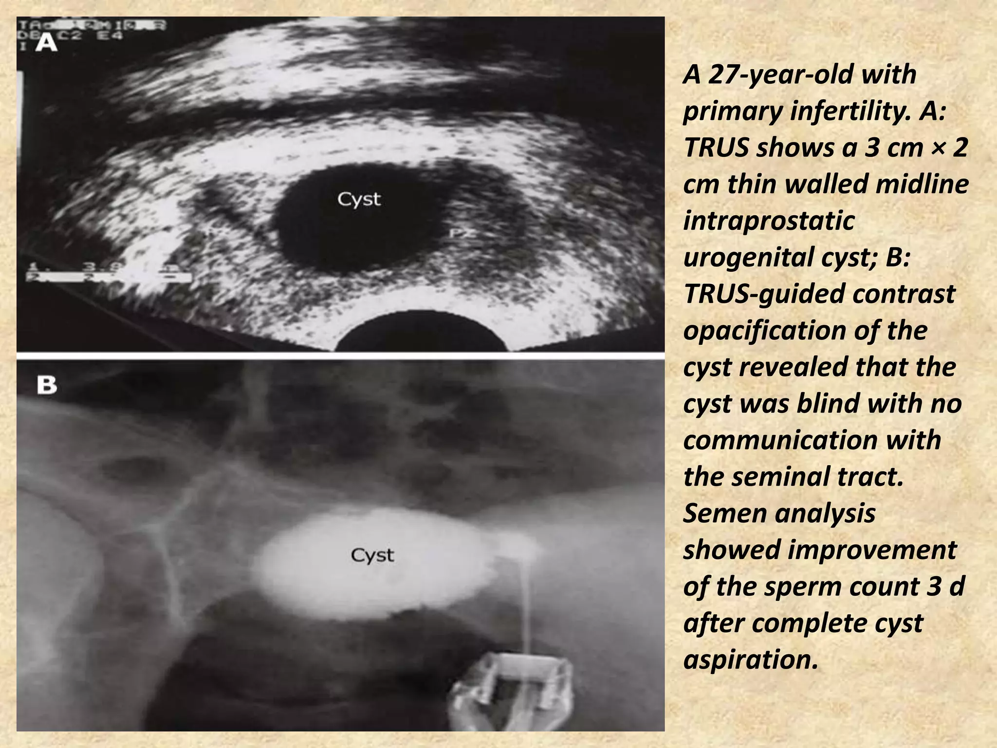 Presentation1.pptx, radiological imaging of male infertility. | PPTX