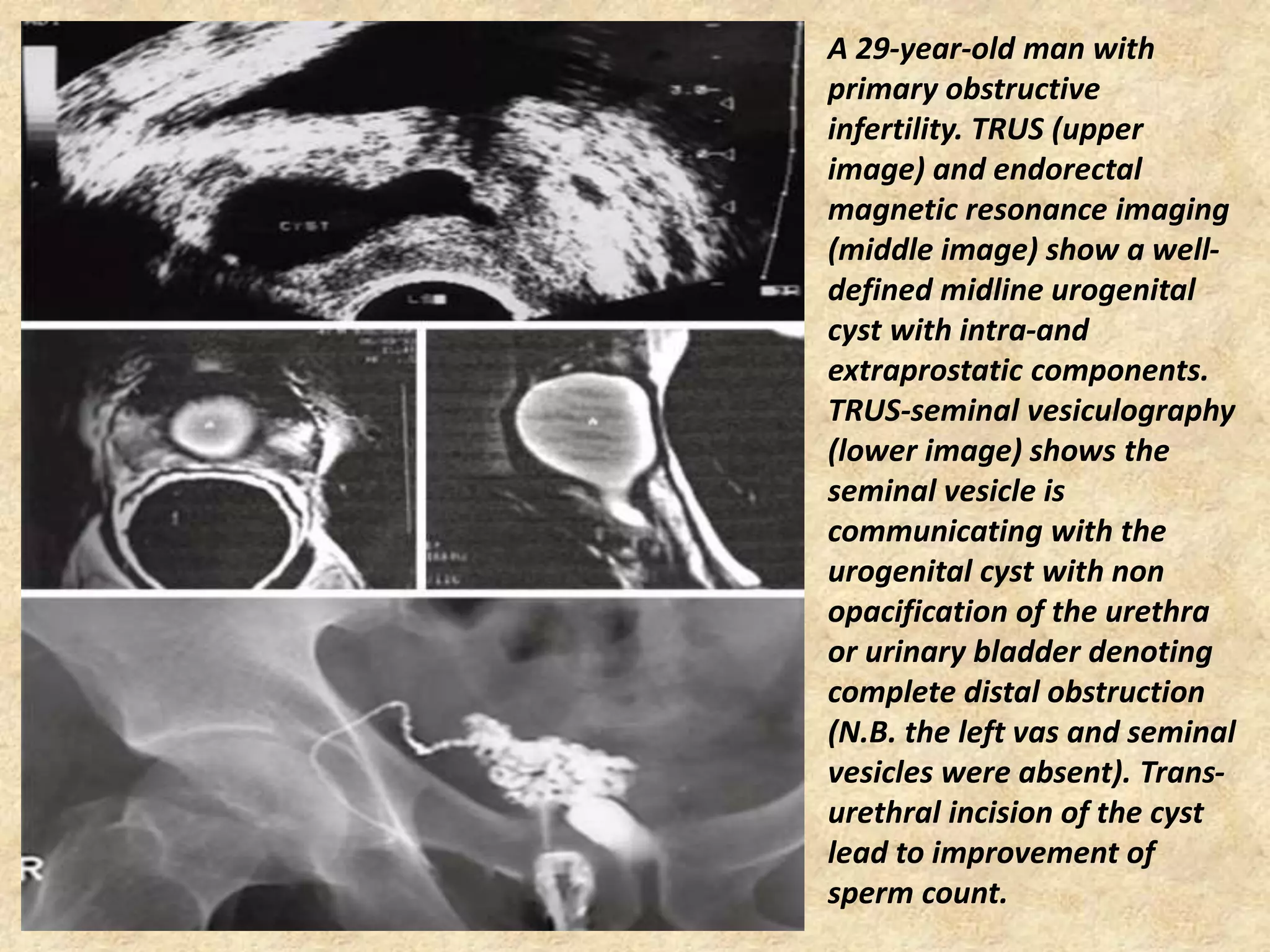 Presentation1.pptx, radiological imaging of male infertility. | PPTX