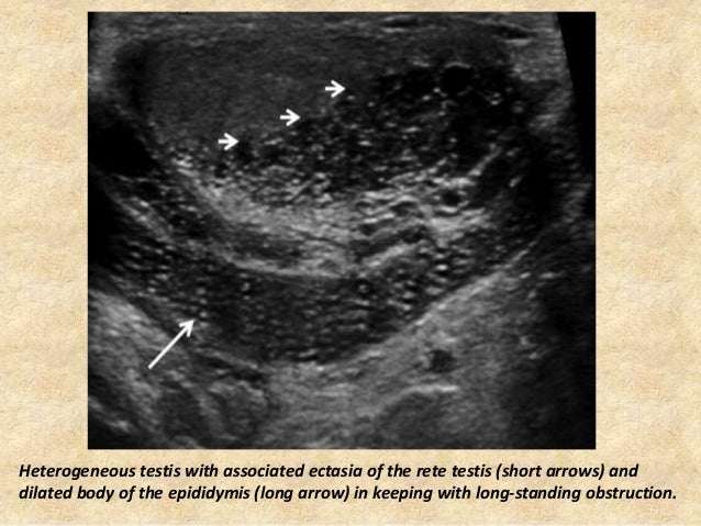 Presentation1.pptx, radiological imaging of male infertility.