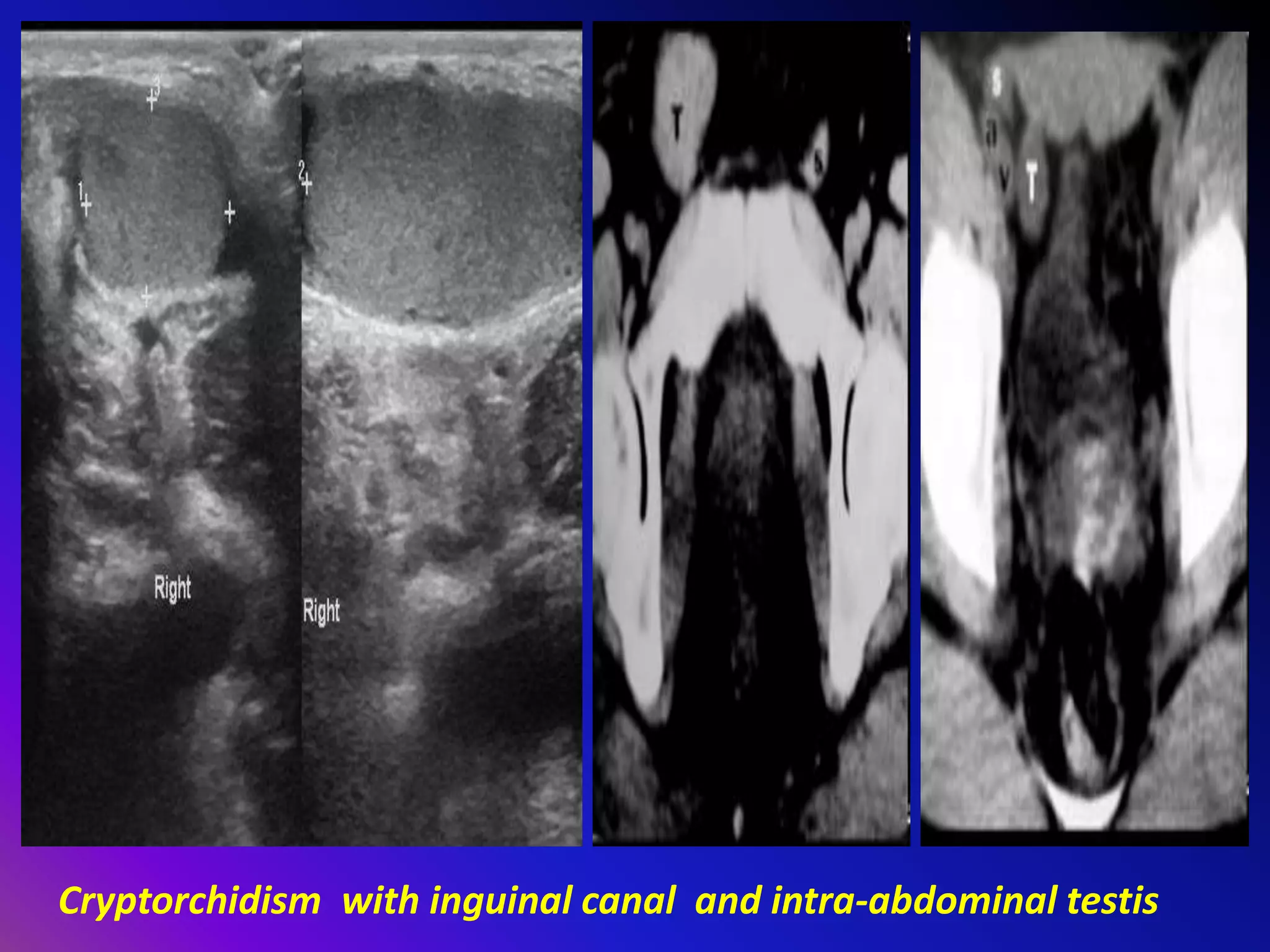 Presentation1.pptx, radiological imaging of scrotal diseases. | PPTX