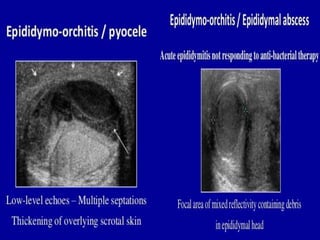 Pyocele Ultrasound