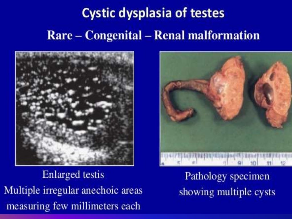 Presentation1 Pptx Radiological Imaging Of Scrotal Diseases