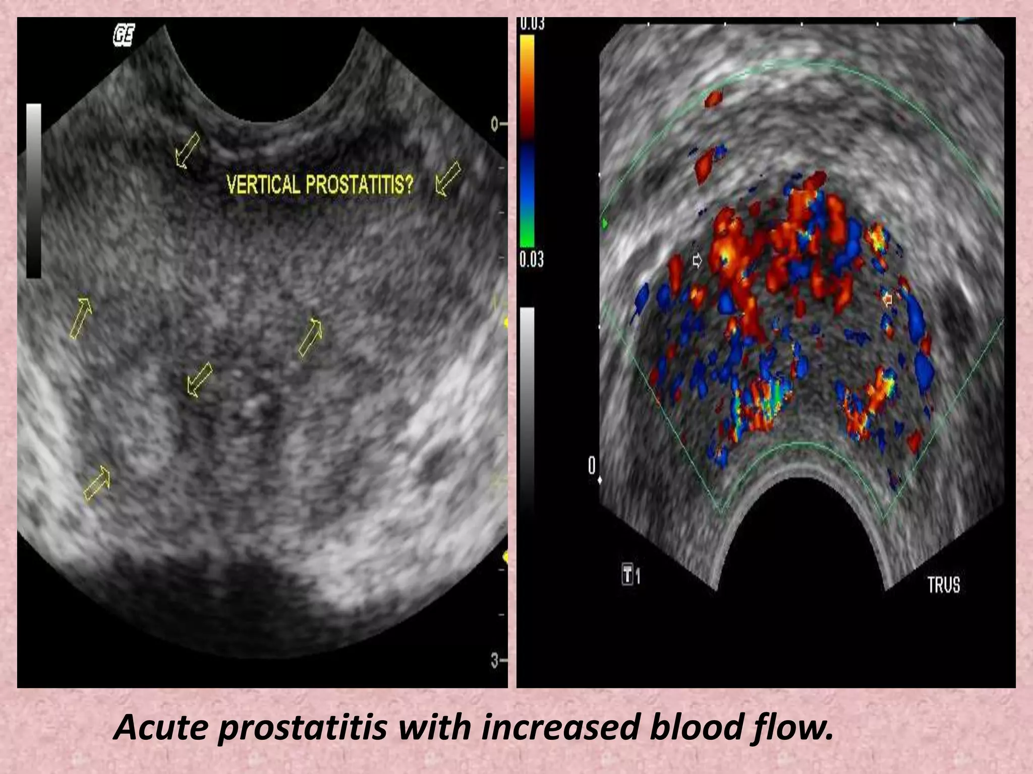 Presentation1.pptx, radiological imaging of prostatic diseases | PPTX
