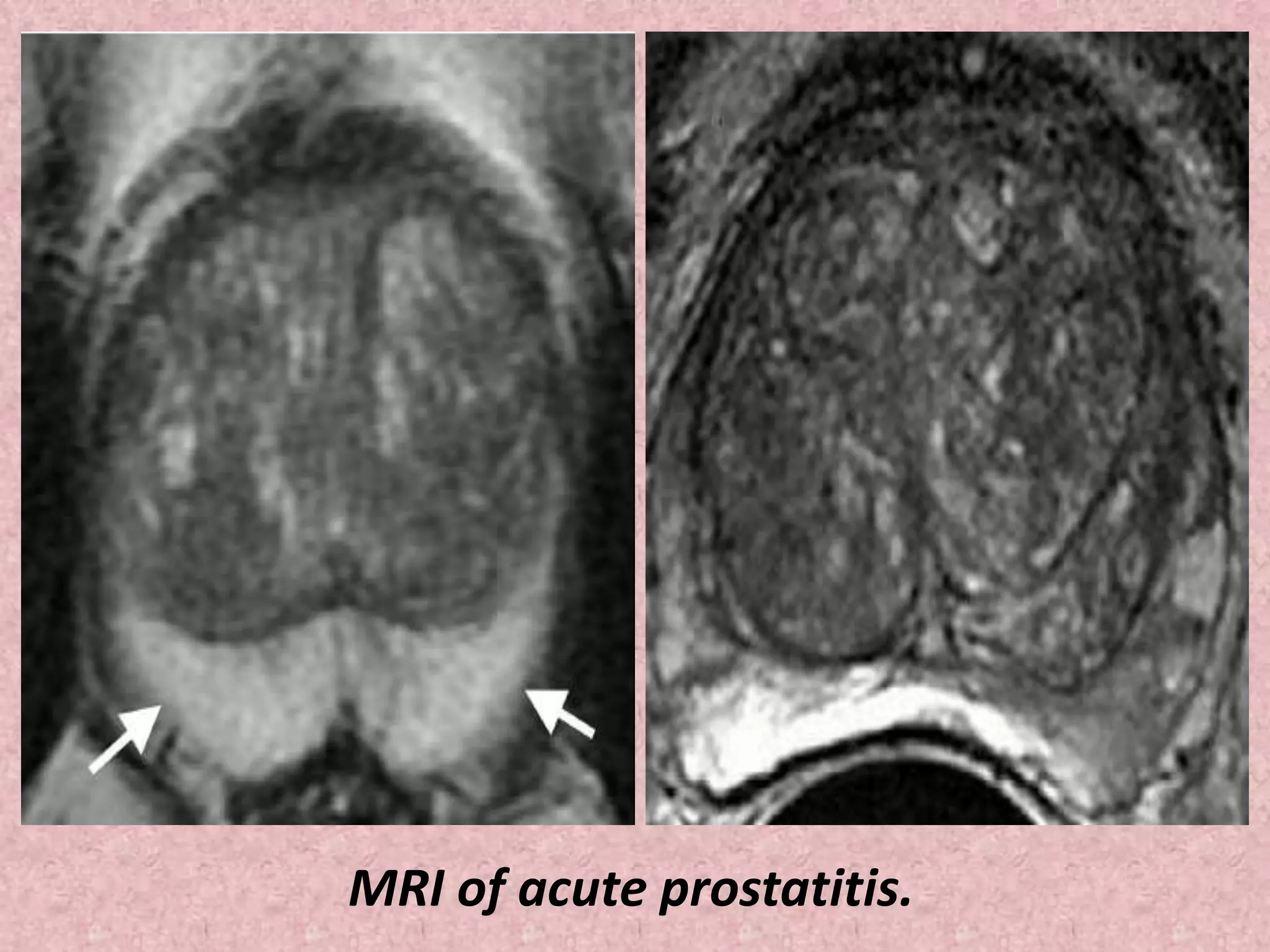 Presentation1.pptx, radiological imaging of prostatic diseases | PPTX