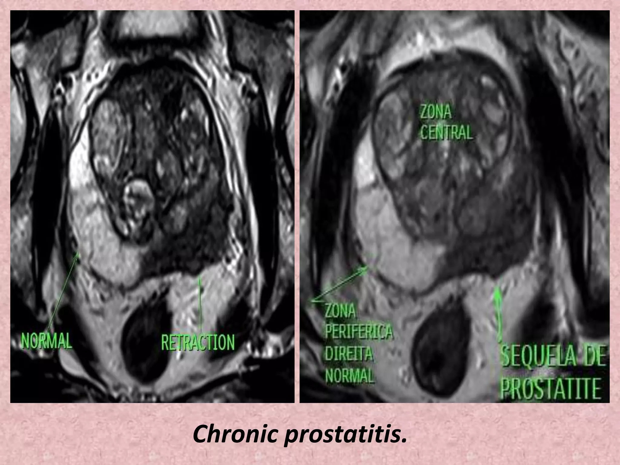 Presentation1.pptx, radiological imaging of prostatic diseases | PPTX