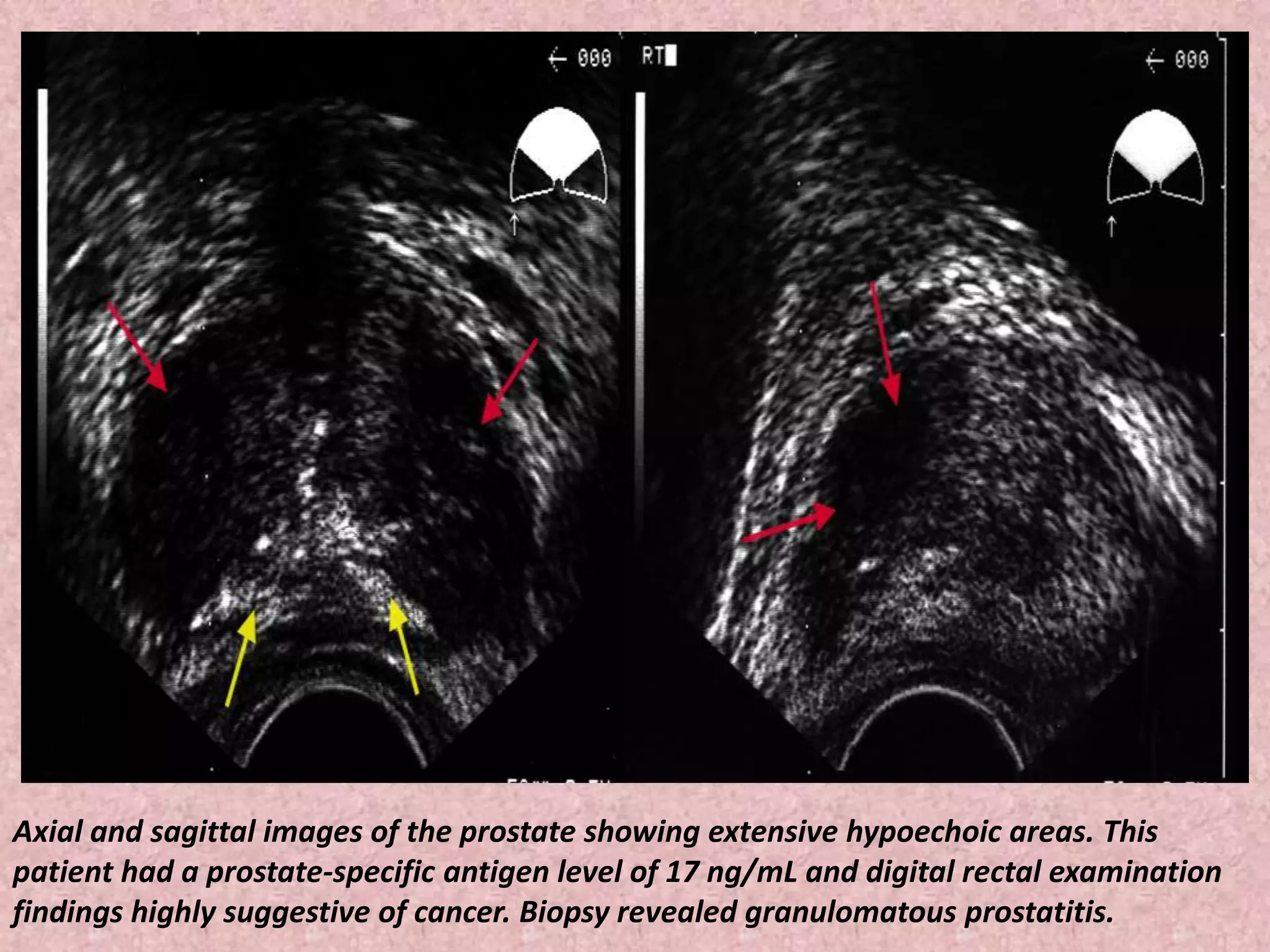 Presentation1.pptx, radiological imaging of prostatic diseases | PPTX