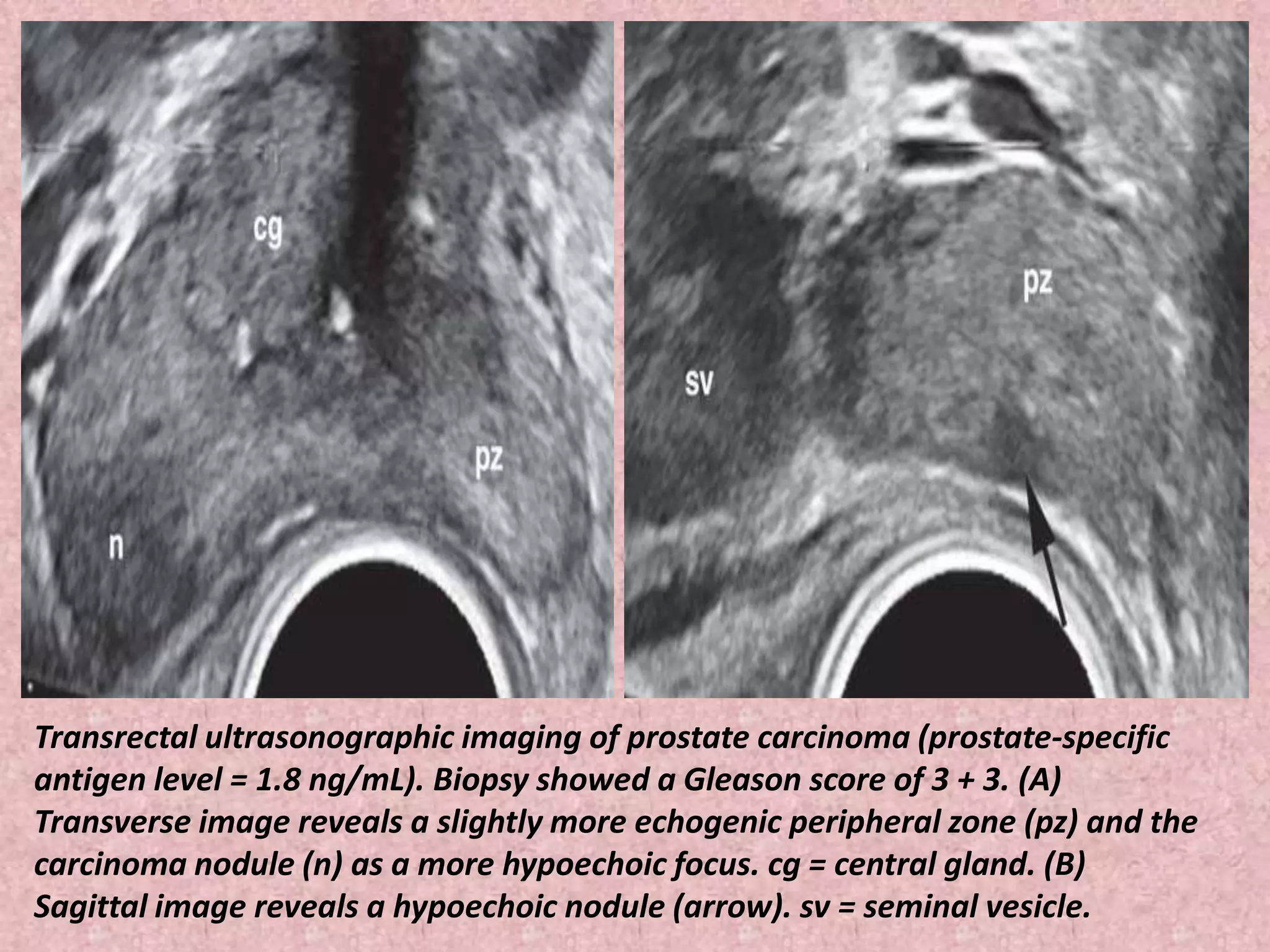 Presentation1.pptx, radiological imaging of prostatic diseases | PPTX