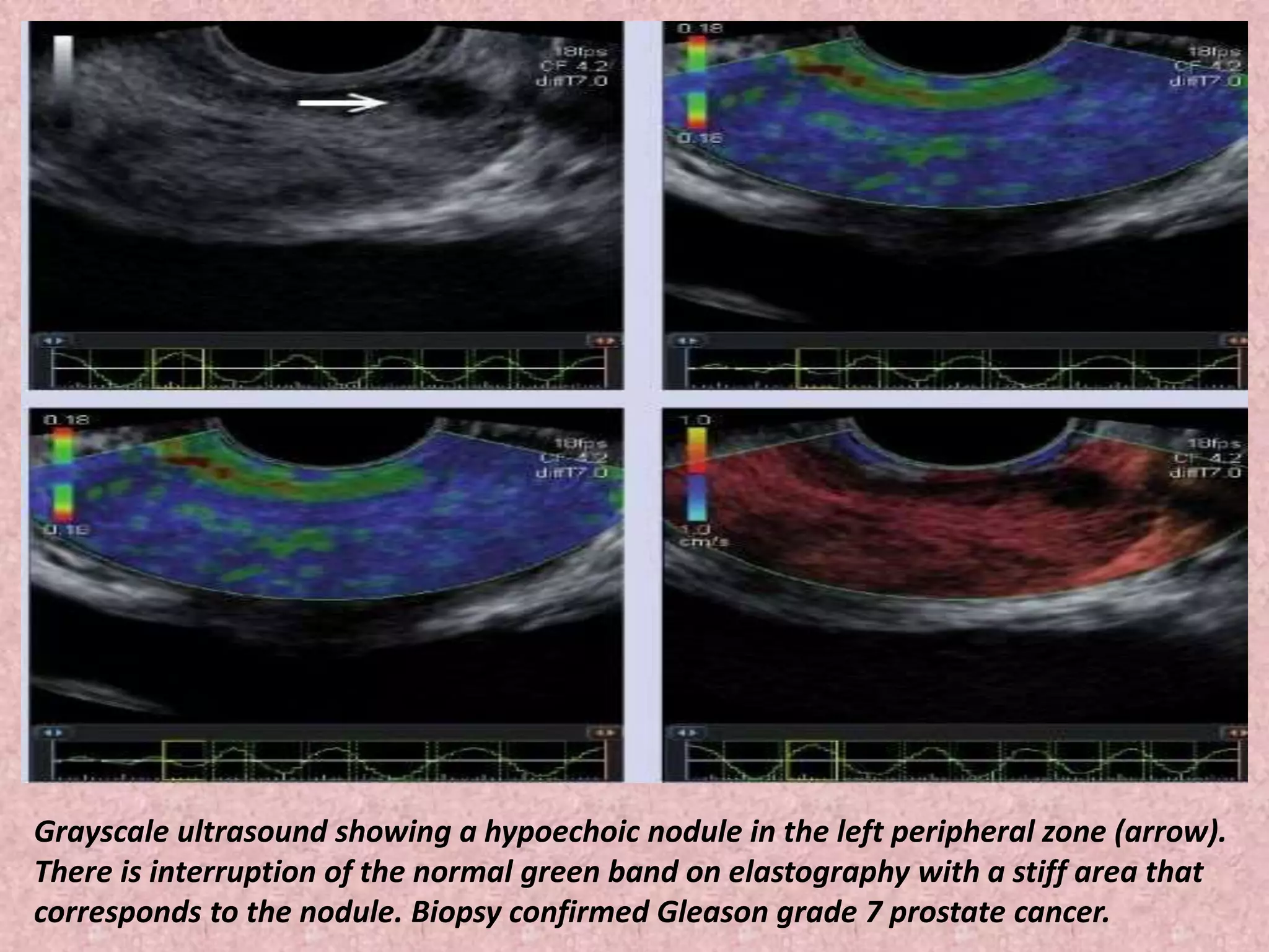 Presentation1.pptx, radiological imaging of prostatic diseases | PPTX