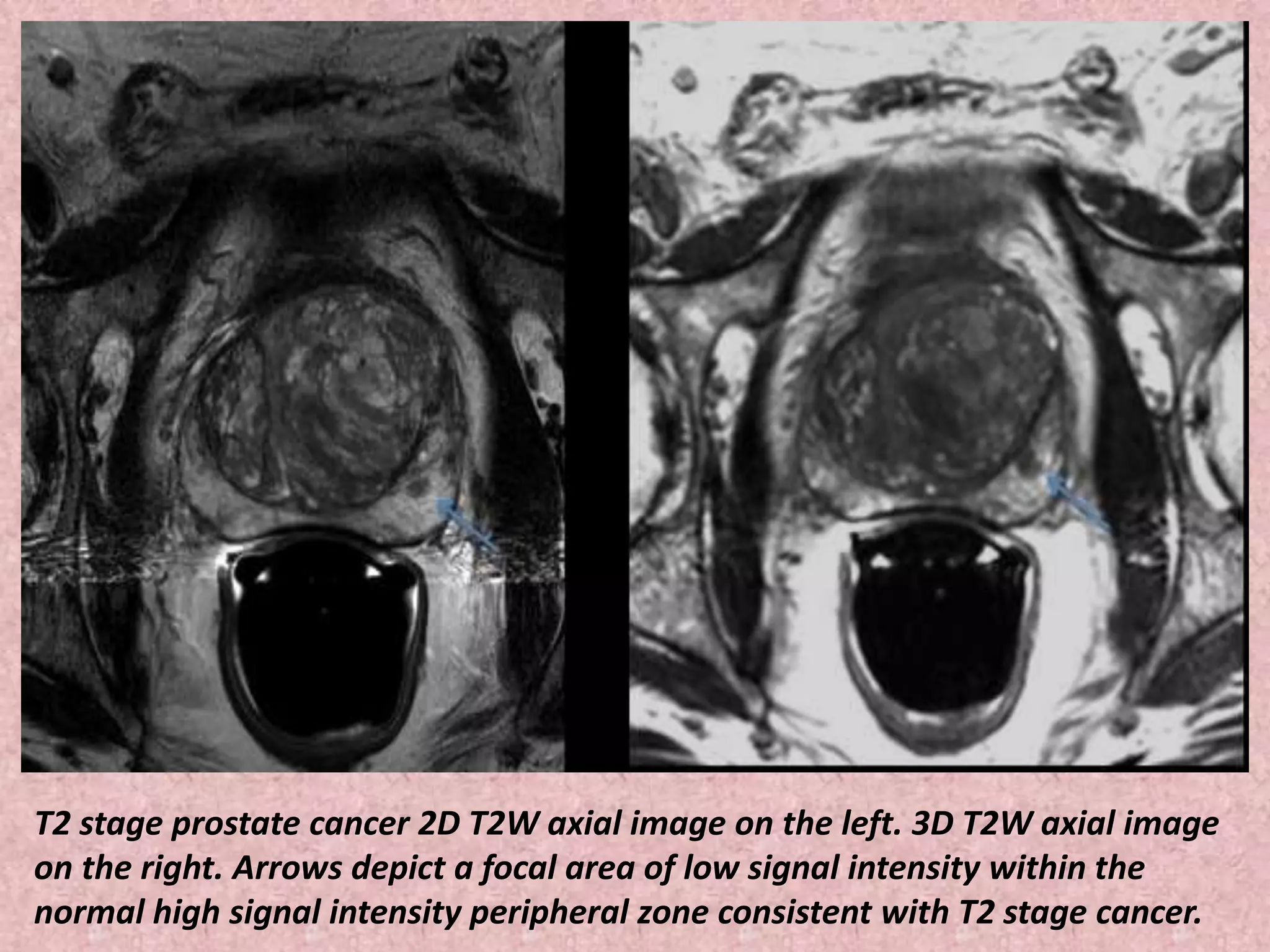 Presentation1.pptx, radiological imaging of prostatic diseases | PPTX