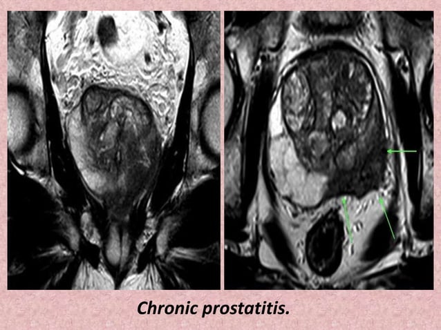 Presentation1.pptx, radiological imaging of prostatic diseases | PPTX
