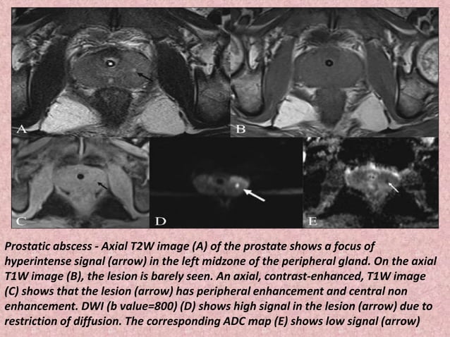 Presentation1.pptx, radiological imaging of prostatic diseases | PPTX