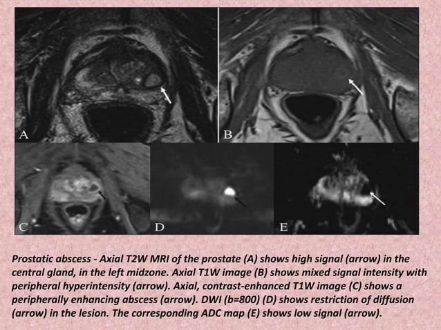 Presentation1.pptx, radiological imaging of prostatic diseases | PPTX