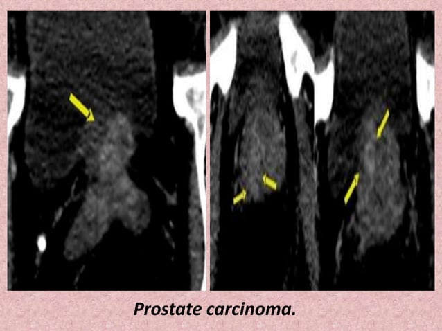 Presentation1.pptx, radiological imaging of prostatic diseases | PPTX