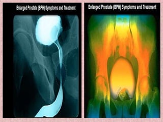 Enlarged Prostate X Ray