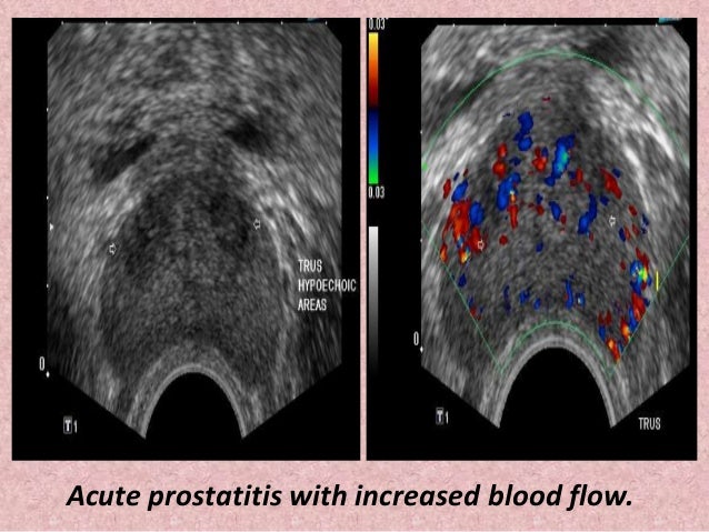 Presentation1.pptx, radiological imaging of prostatic diseases