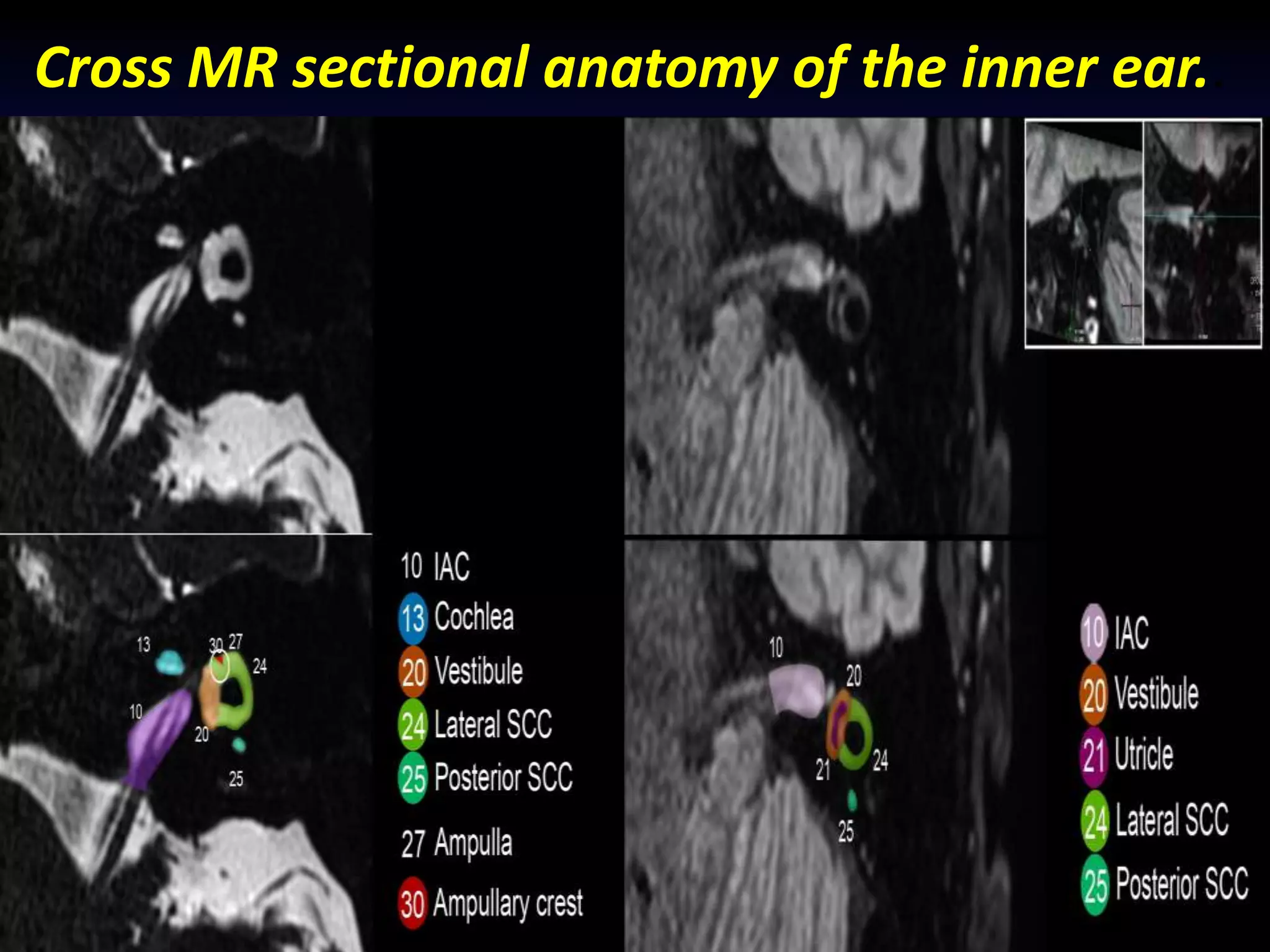 Presentation1.pptx, radiological imaging of inner ear diseases | PPTX ...