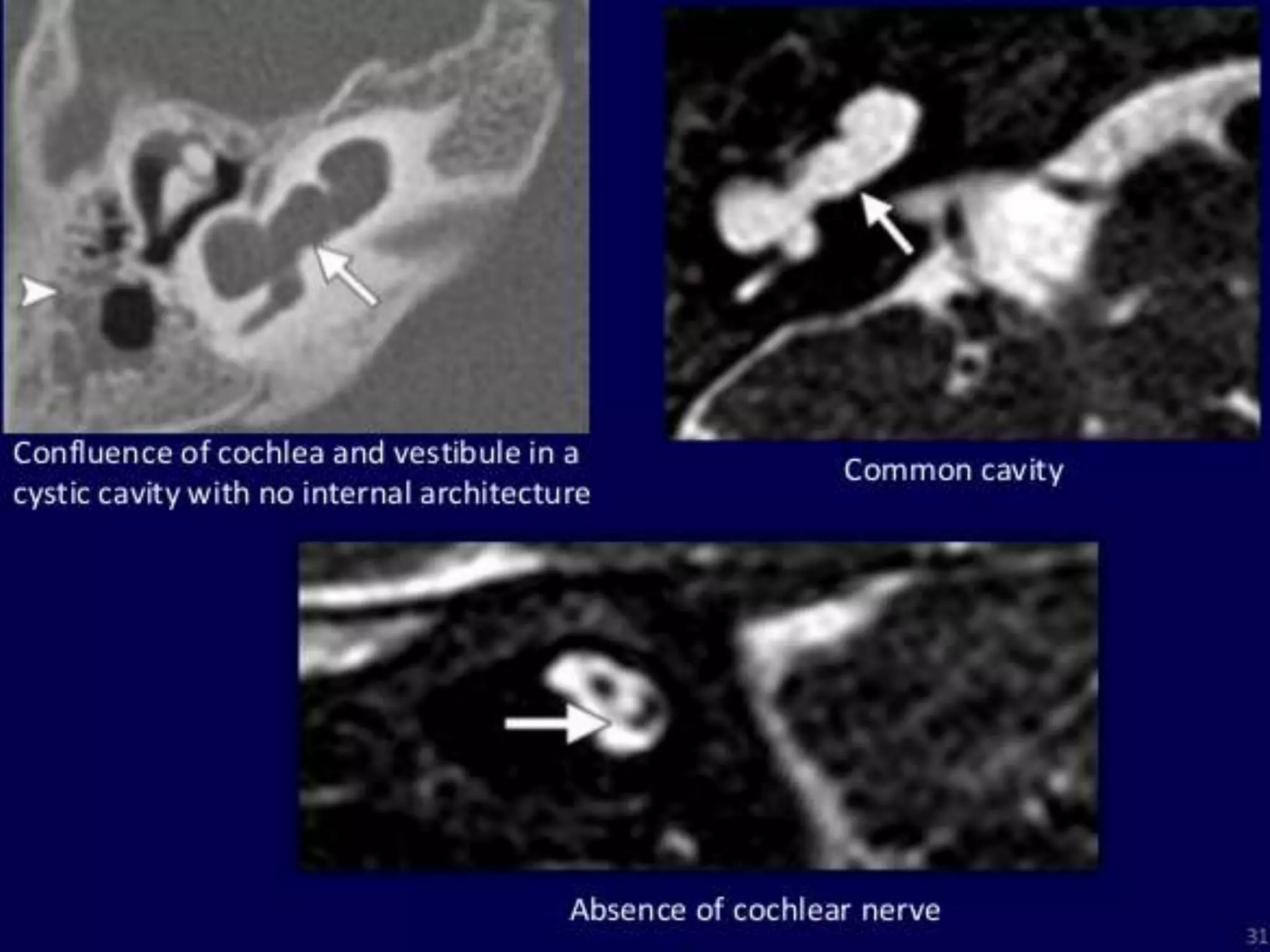 Presentation1.pptx, radiological imaging of inner ear diseases | PPTX