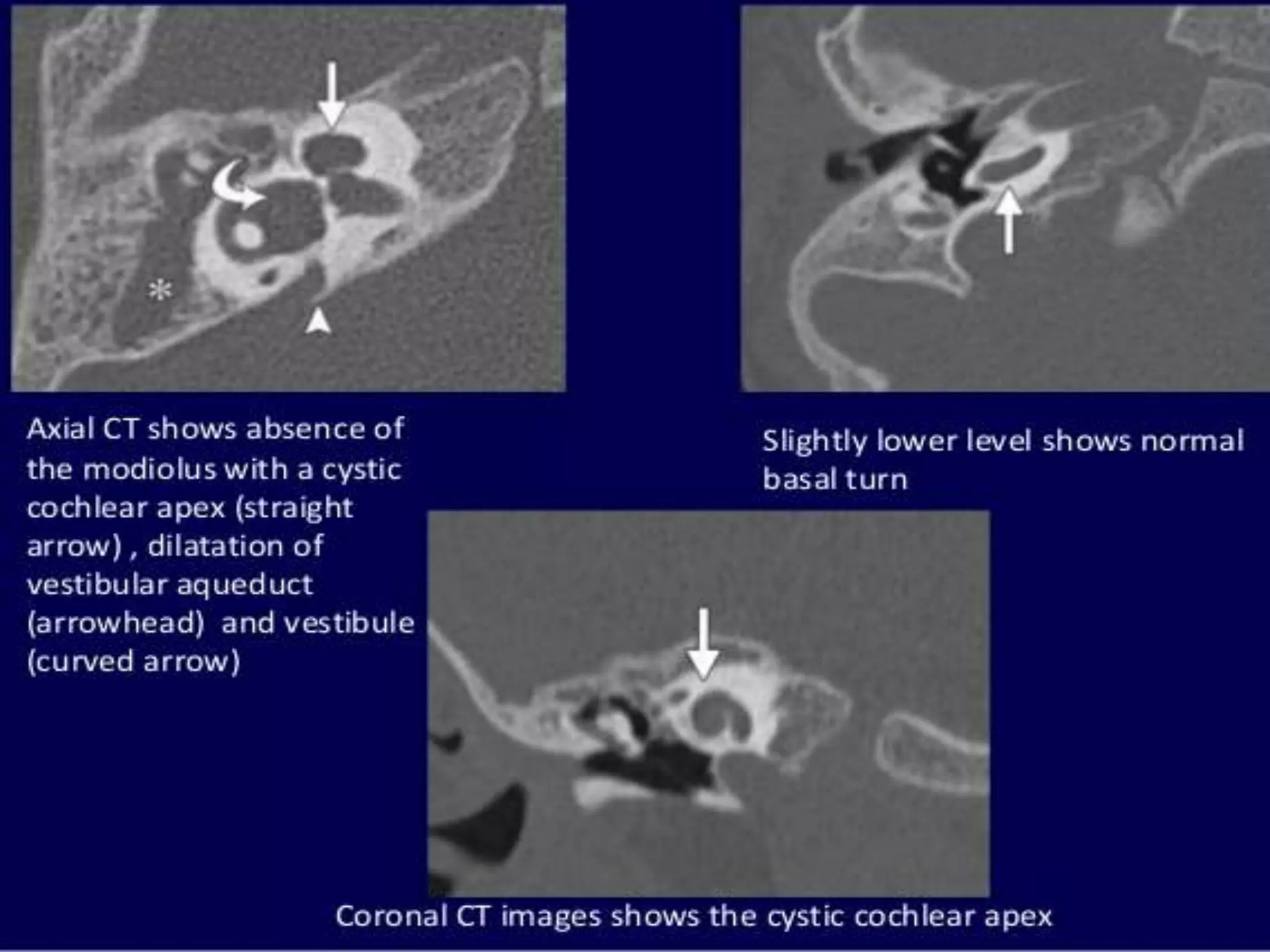 Presentation1.pptx, radiological imaging of inner ear diseases | PPTX