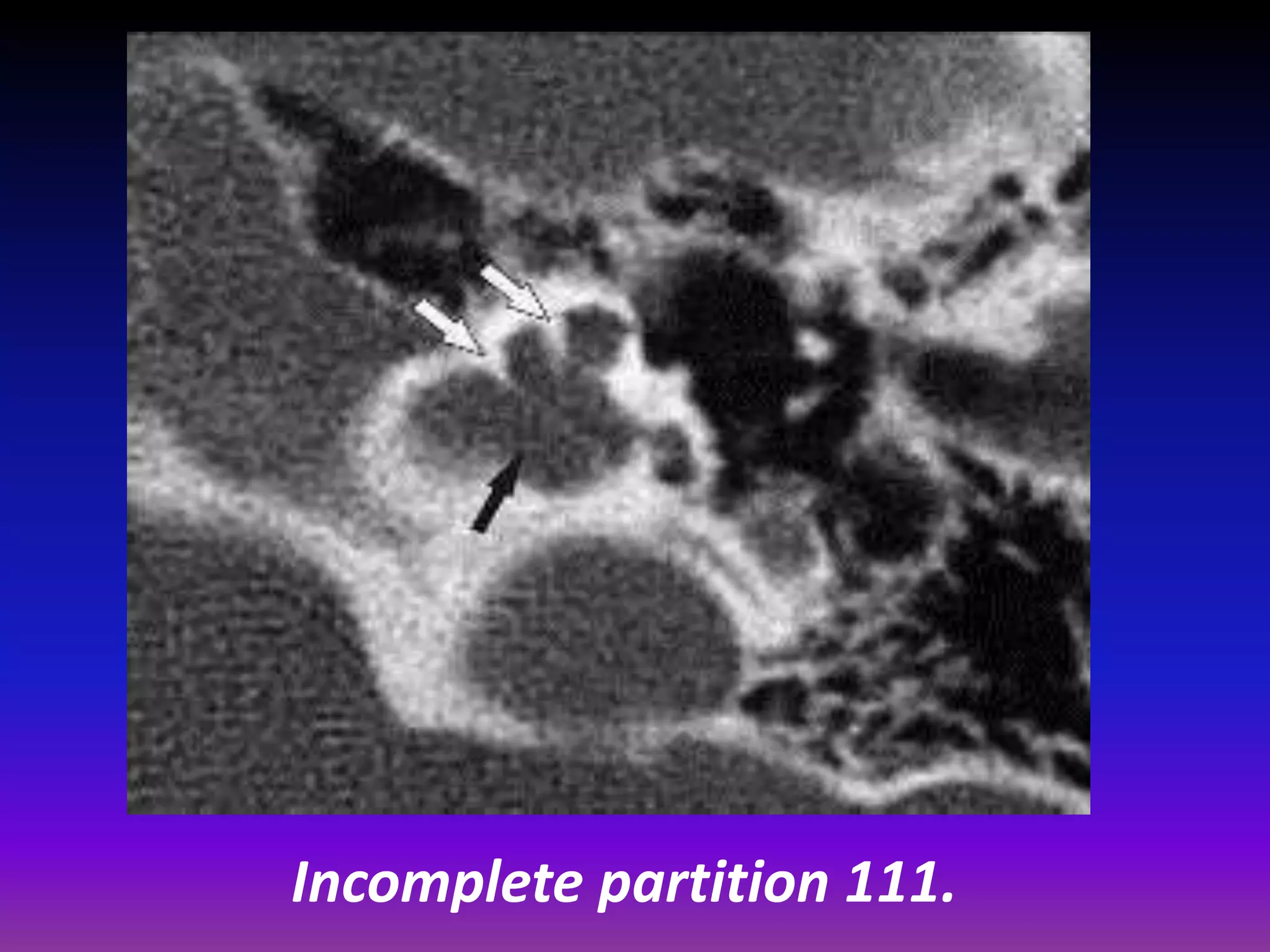 Presentation1.pptx, radiological imaging of inner ear diseases | PPTX