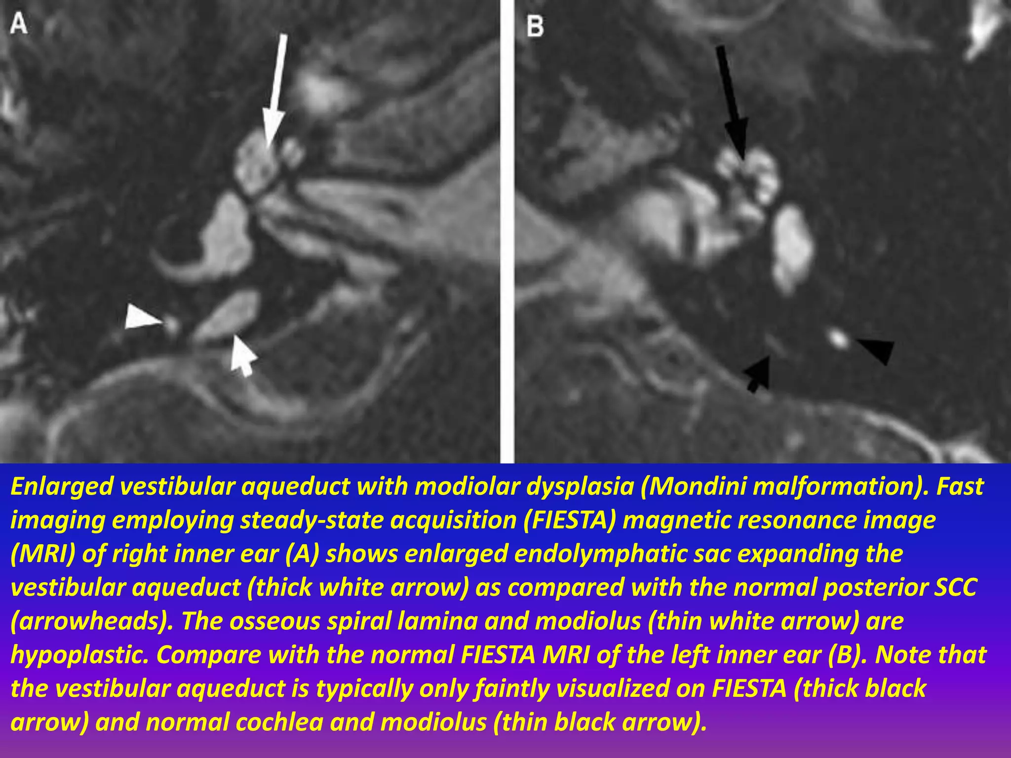 Presentation1.pptx, radiological imaging of inner ear diseases | PPTX