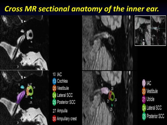 Presentation1.pptx, radiological imaging of inner ear diseases | PPTX ...