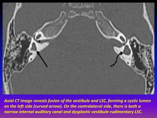 Presentation1.pptx, radiological imaging of inner ear diseases | PPTX