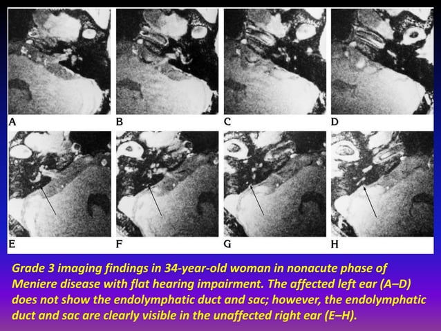 Presentation1.pptx, radiological imaging of inner ear diseases