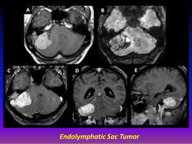 Presentation1.pptx, radiological imaging of inner ear diseases