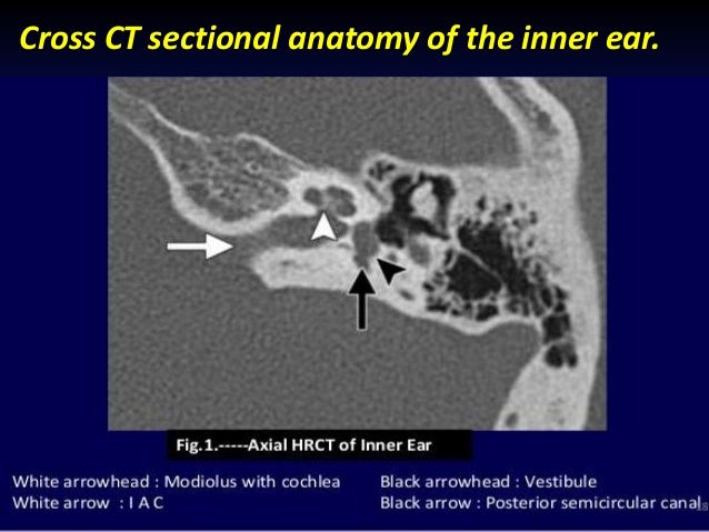 Presentation1.pptx, radiological imaging of inner ear diseases