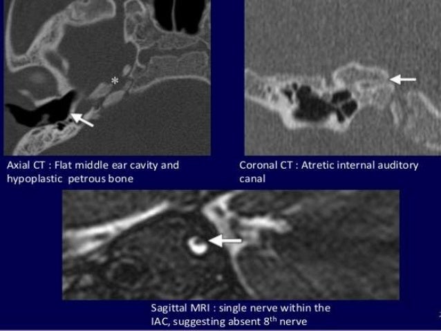 Presentation1.pptx, radiological imaging of inner ear diseases
