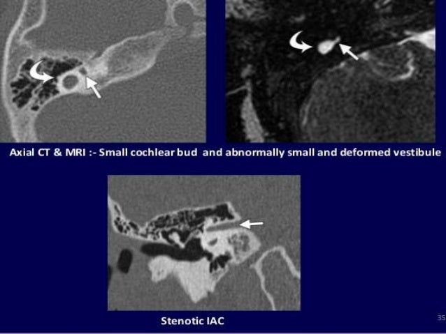 Presentation1.pptx, radiological imaging of inner ear diseases
