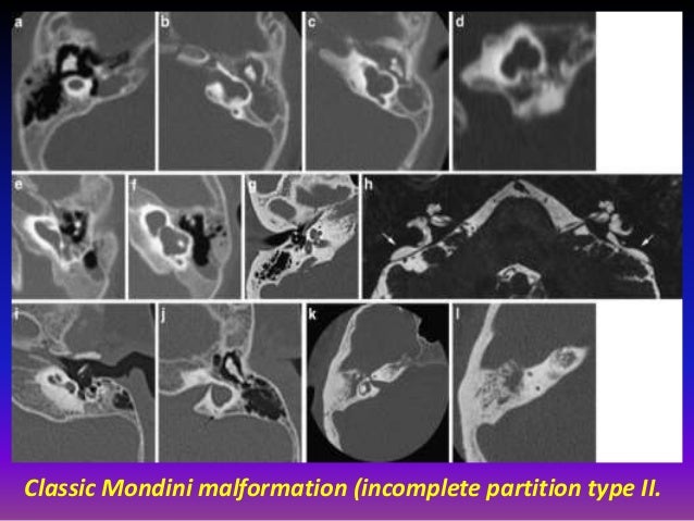 Presentation1.pptx, radiological imaging of inner ear diseases