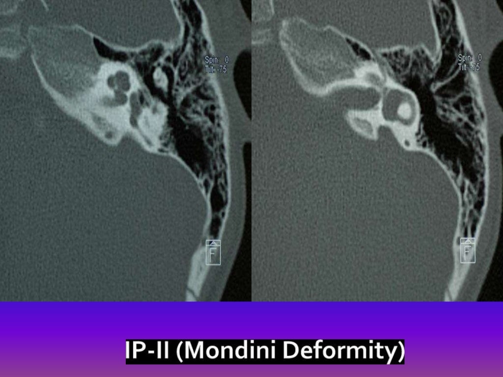Presentation1.pptx, radiological imaging of inner ear diseases