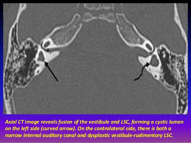 Presentation1.pptx, radiological imaging of inner ear diseases