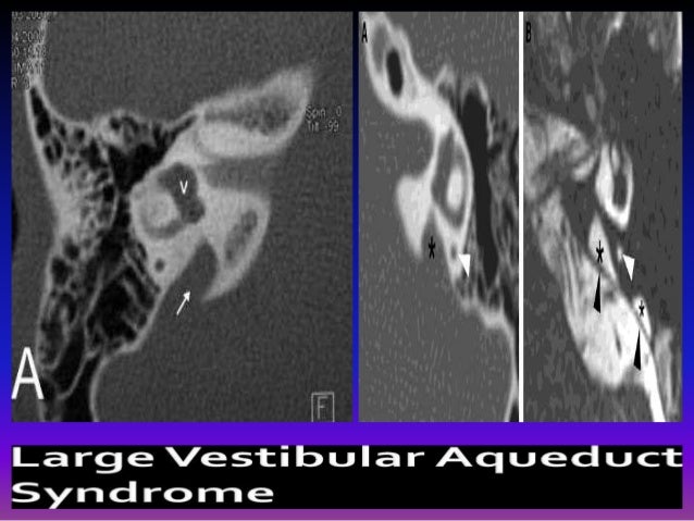 Presentation1.pptx, radiological imaging of inner ear diseases