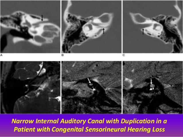 Presentation1.pptx, radiological imaging of inner ear diseases