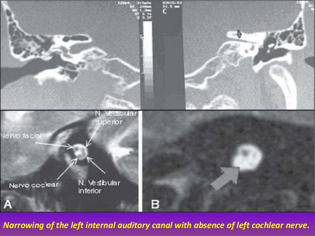Presentation1.pptx, radiological imaging of inner ear diseases