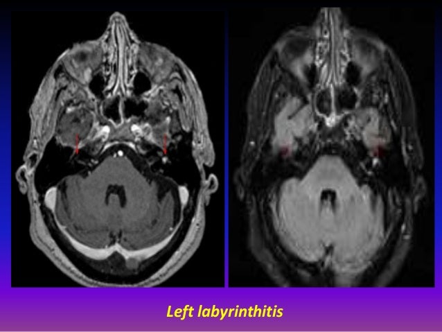Presentation1.pptx, radiological imaging of inner ear diseases