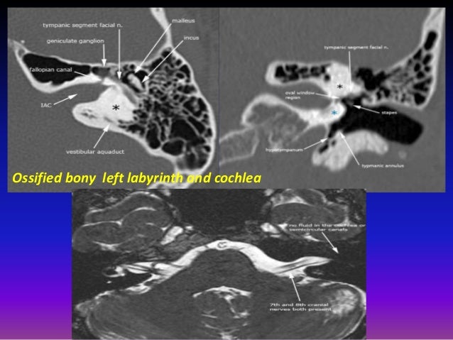Presentation1.pptx, radiological imaging of inner ear diseases
