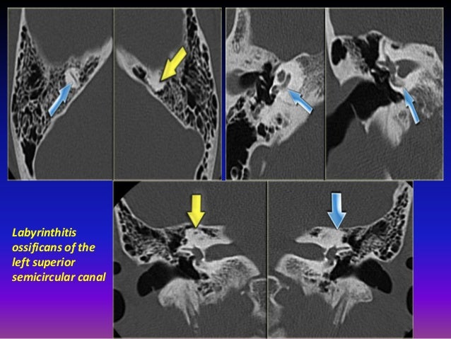 Presentation1.pptx, radiological imaging of inner ear diseases