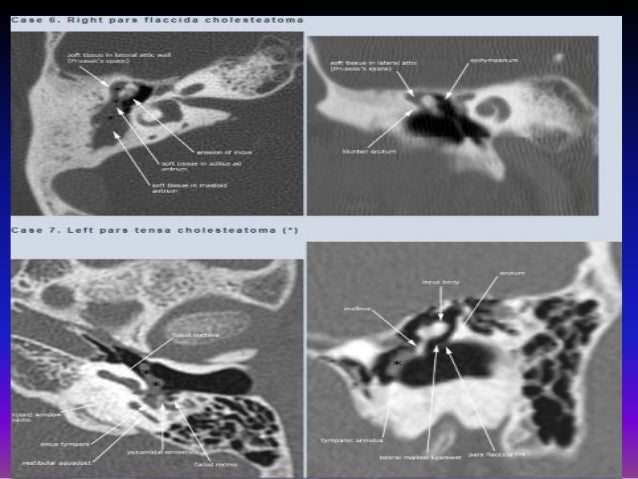 Presentation1.pptx, radiological imaging of inner ear diseases