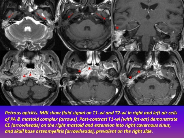 Presentation1.pptx, radiological imaging of inner ear diseases