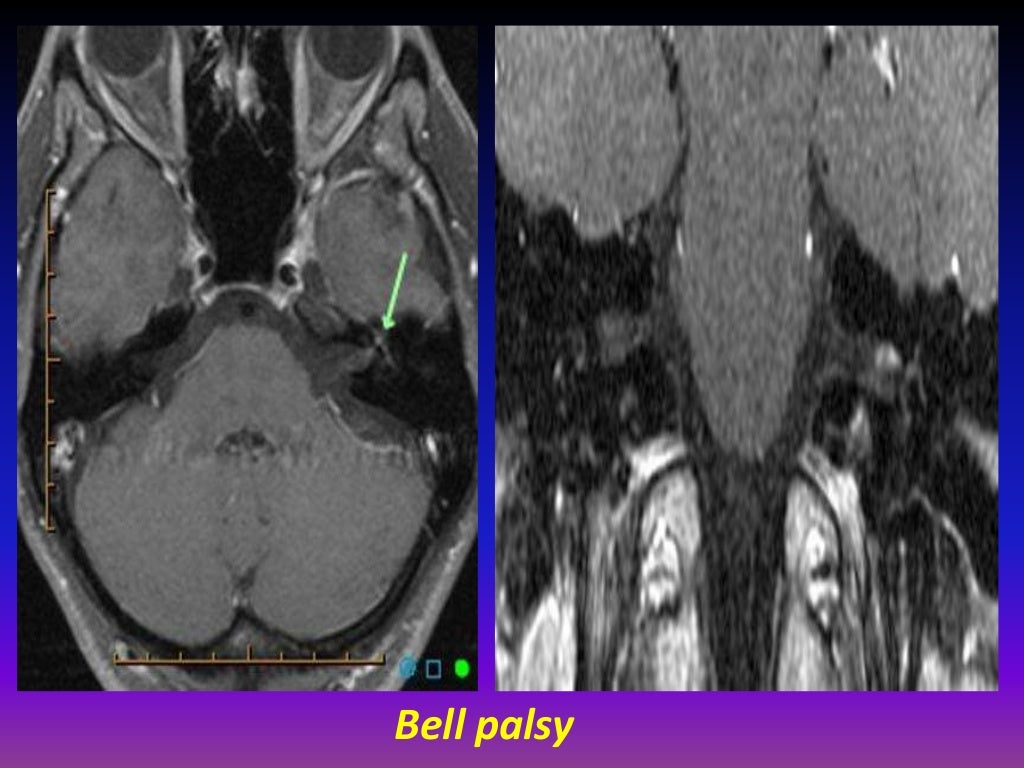 Presentation1.pptx, radiological imaging of inner ear diseases