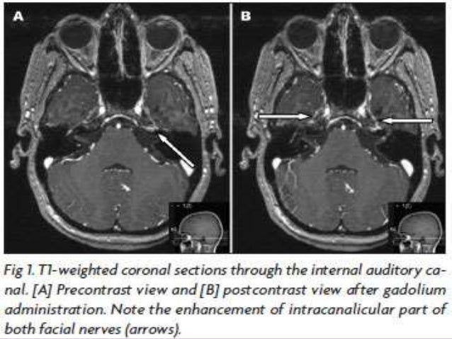 Mri Inner Ear Dizziness