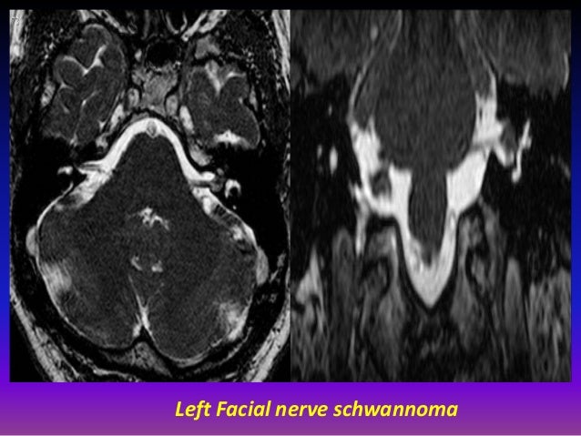 Presentation1.pptx, radiological imaging of inner ear diseases