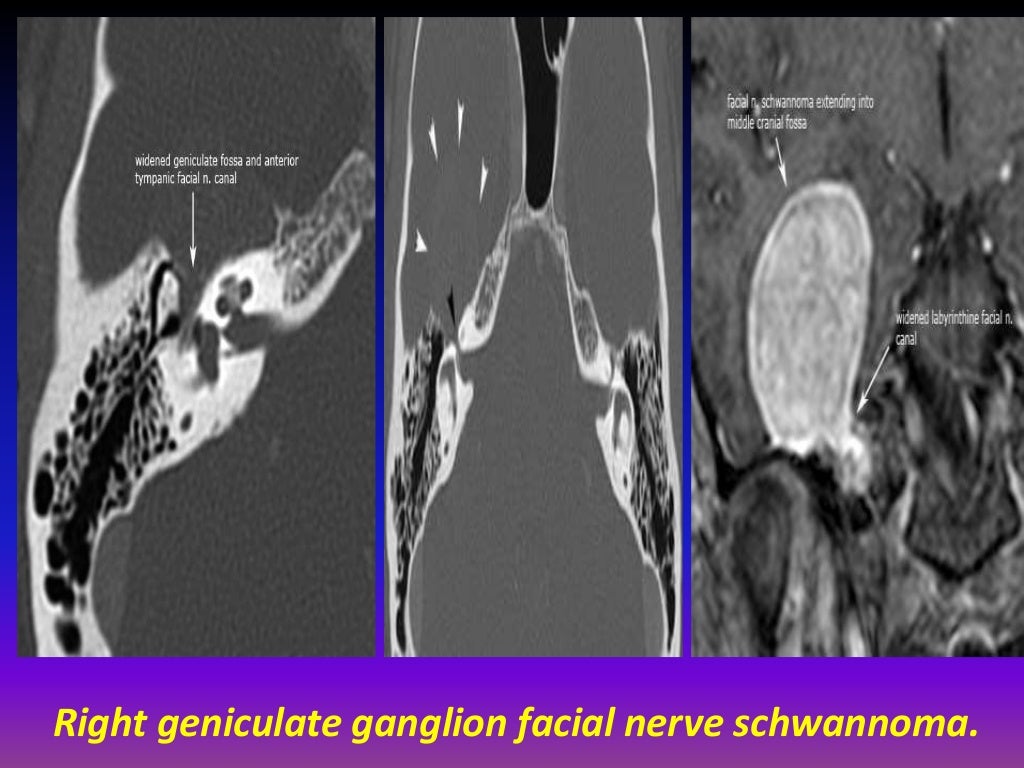 Presentation1.pptx, radiological imaging of inner ear diseases