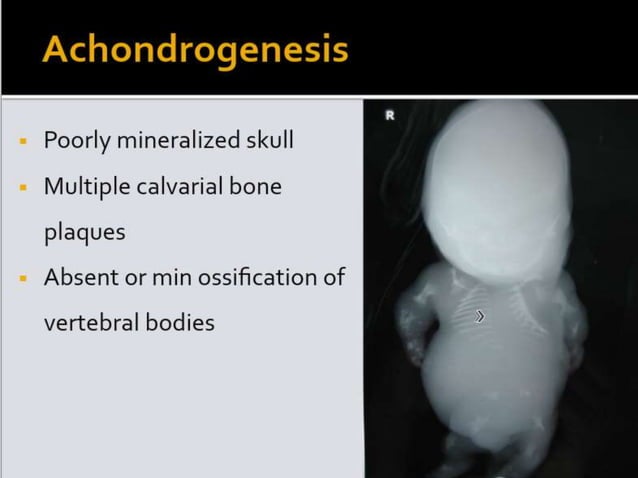 Presentation1.pptx, radiological imaging of skeletal dysplasia | PPTX